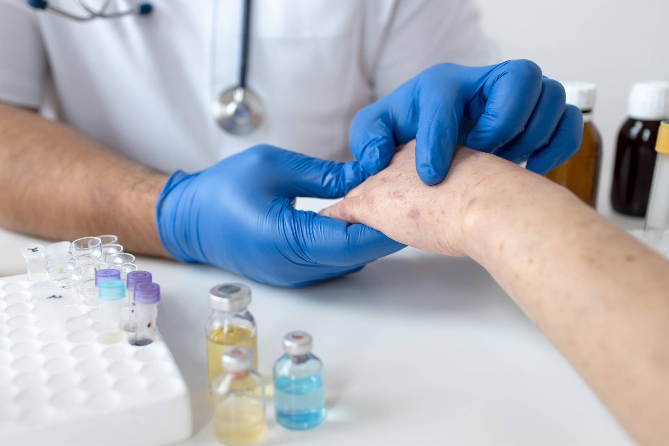 Managing Lupus Flares: Symptoms and treatment options